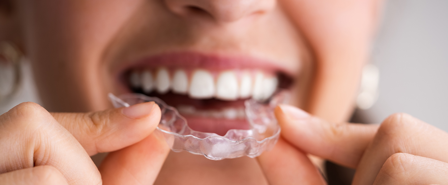 Digital Dental Night Guards Near You in Houston TX 77098